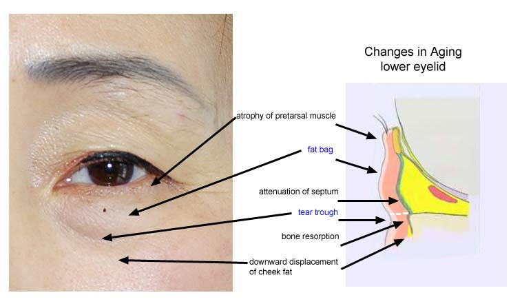 Transconjunctival fat transfer – OZ Cosmetic Clinic