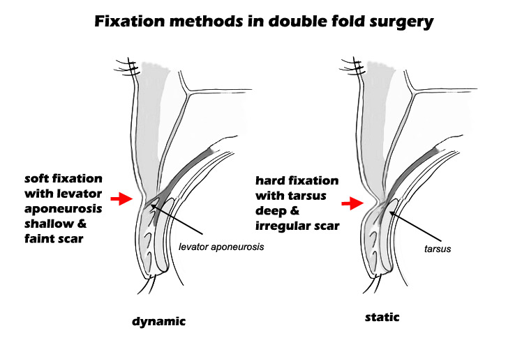 Sausage eyelid ? – OZ Cosmetic Clinic