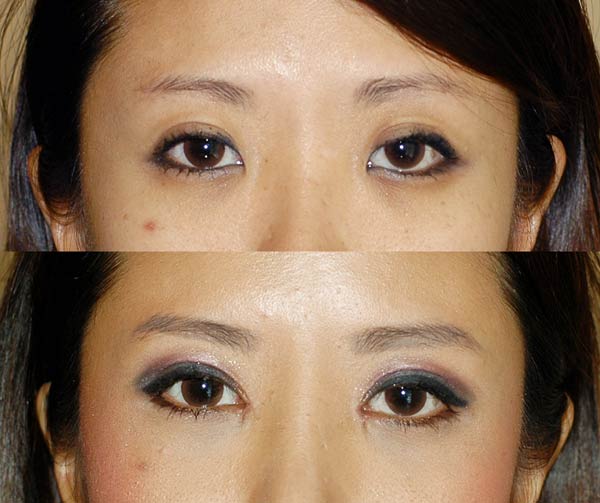Sausage eyelid ? – OZ Cosmetic Clinic
