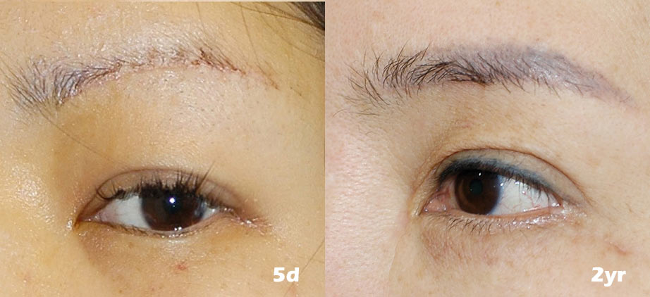 subbrow lifting – OZ Cosmetic Clinic