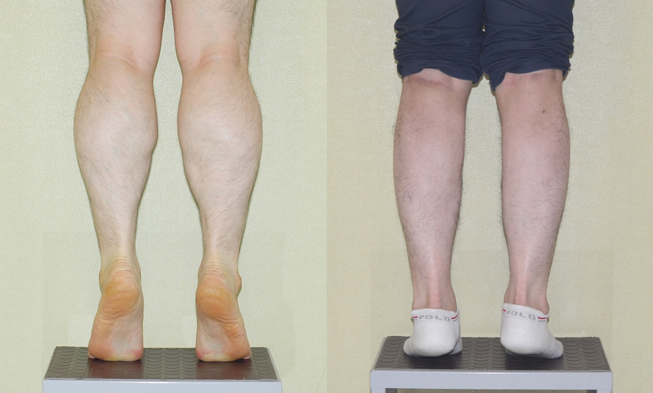 The beauty of men’s calf – OZ Cosmetic Clinic